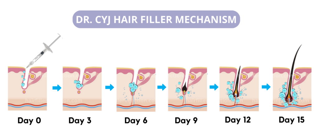DR. CYJ HAIR FILLER | Advanced Hair Loss Treatment