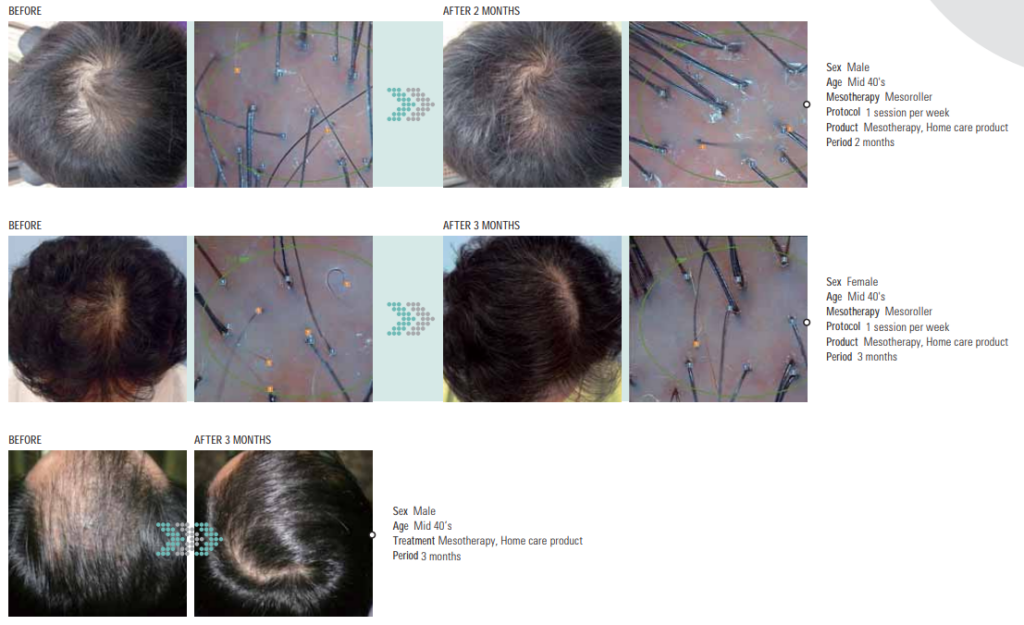 DERMAHEAL Anti-Hair Loss | Proven Hair Regrowth Treatment