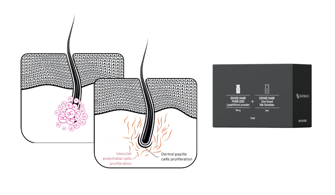 EXOXE HAIR | Hair filler Injection